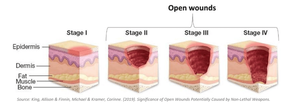 Pressure ulcer may not be an old age problem - ageingray